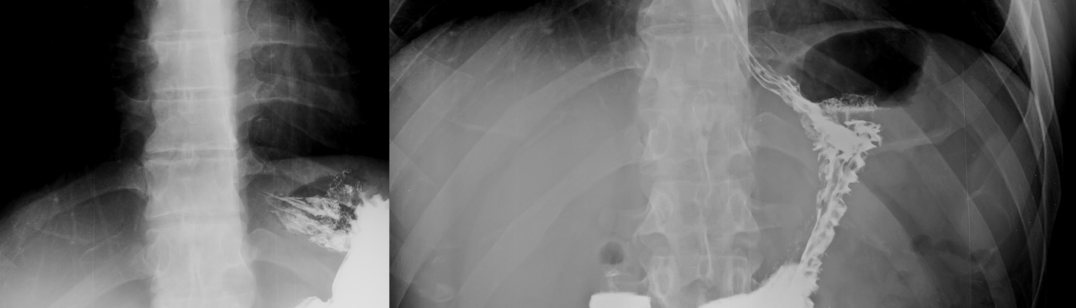 RX / Radiografia Esofago con doppio contrasto in uno dei Centri del ...