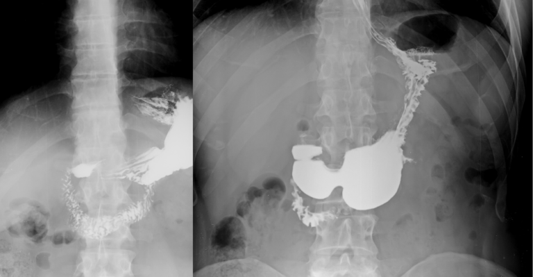 RX / Radiografia Esofago con doppio contrasto in uno dei Centri del ...